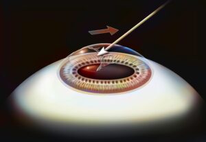 Lasik Surgery in Singapore | Treatment Details and Cost